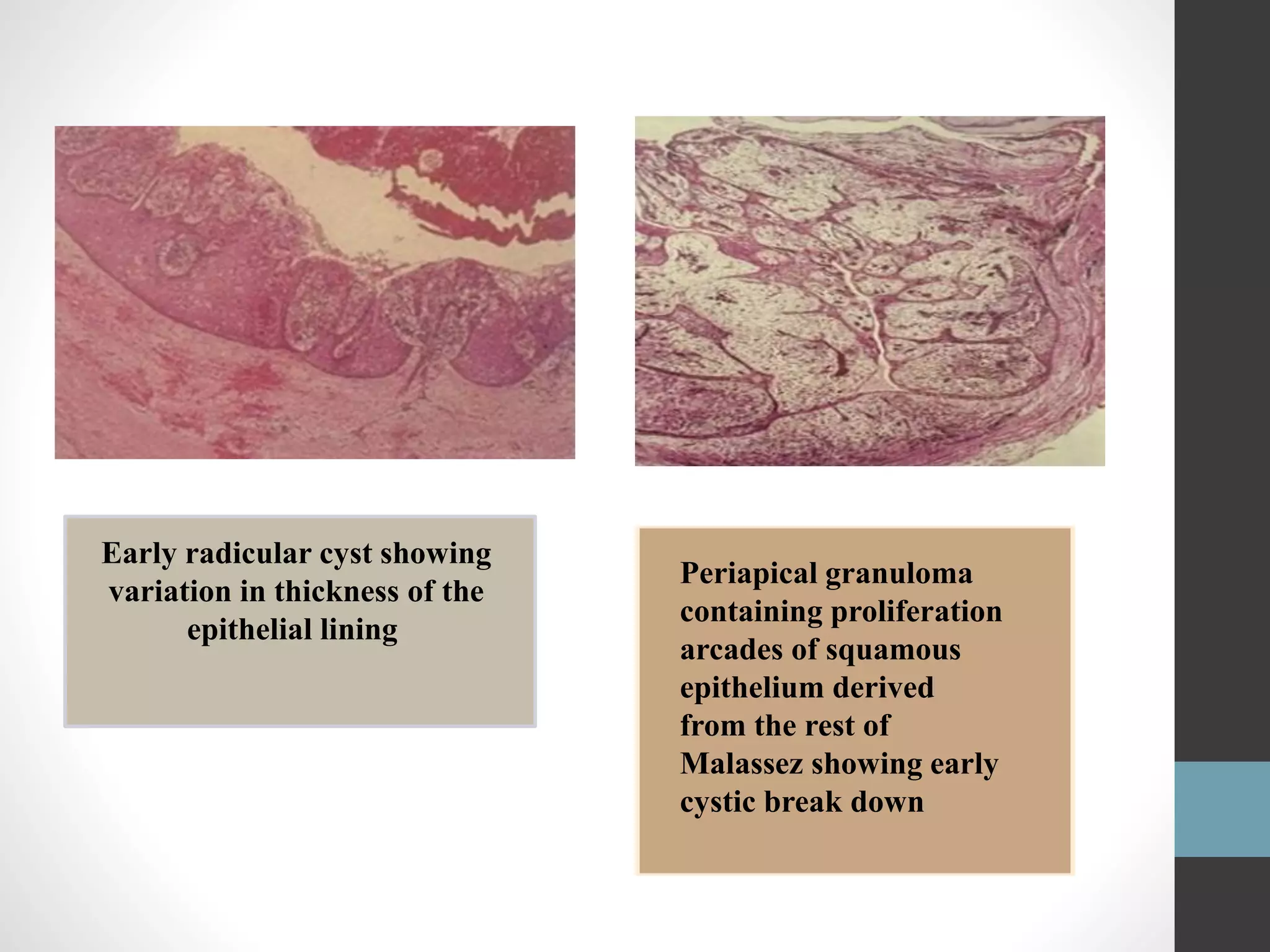 Periapical cyst | PPTX