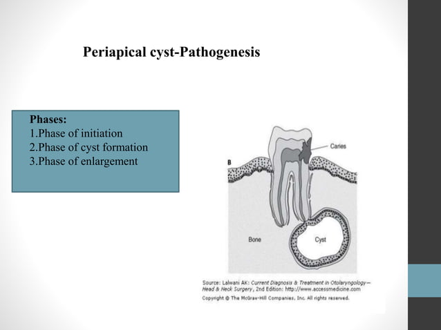 Periapical cyst | PPTX | Dental Health | Diseases and Conditions