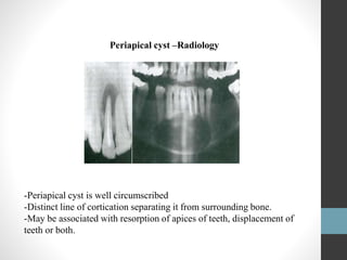 Periapical cyst | PPTX