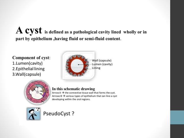 Periapical cyst | PPT