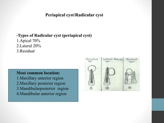 Periapical cyst | PPTX