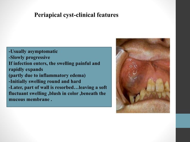 Periapical cyst | PPTX | Dental Health | Diseases and Conditions