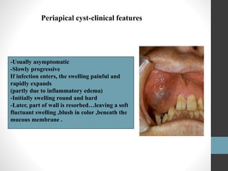 Periapical Cyst