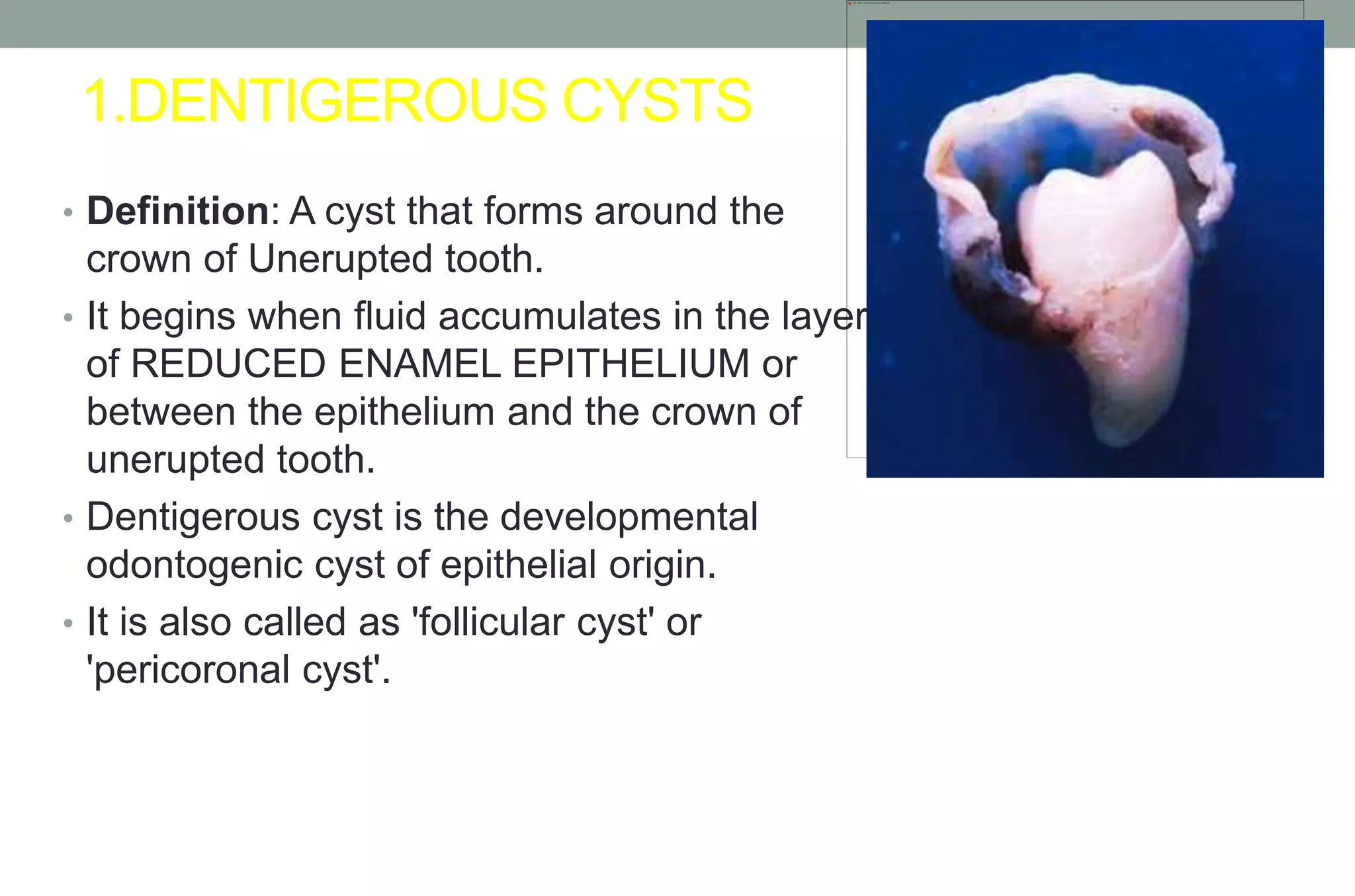 Cyst of oral and maxillofacial regions | PPTX