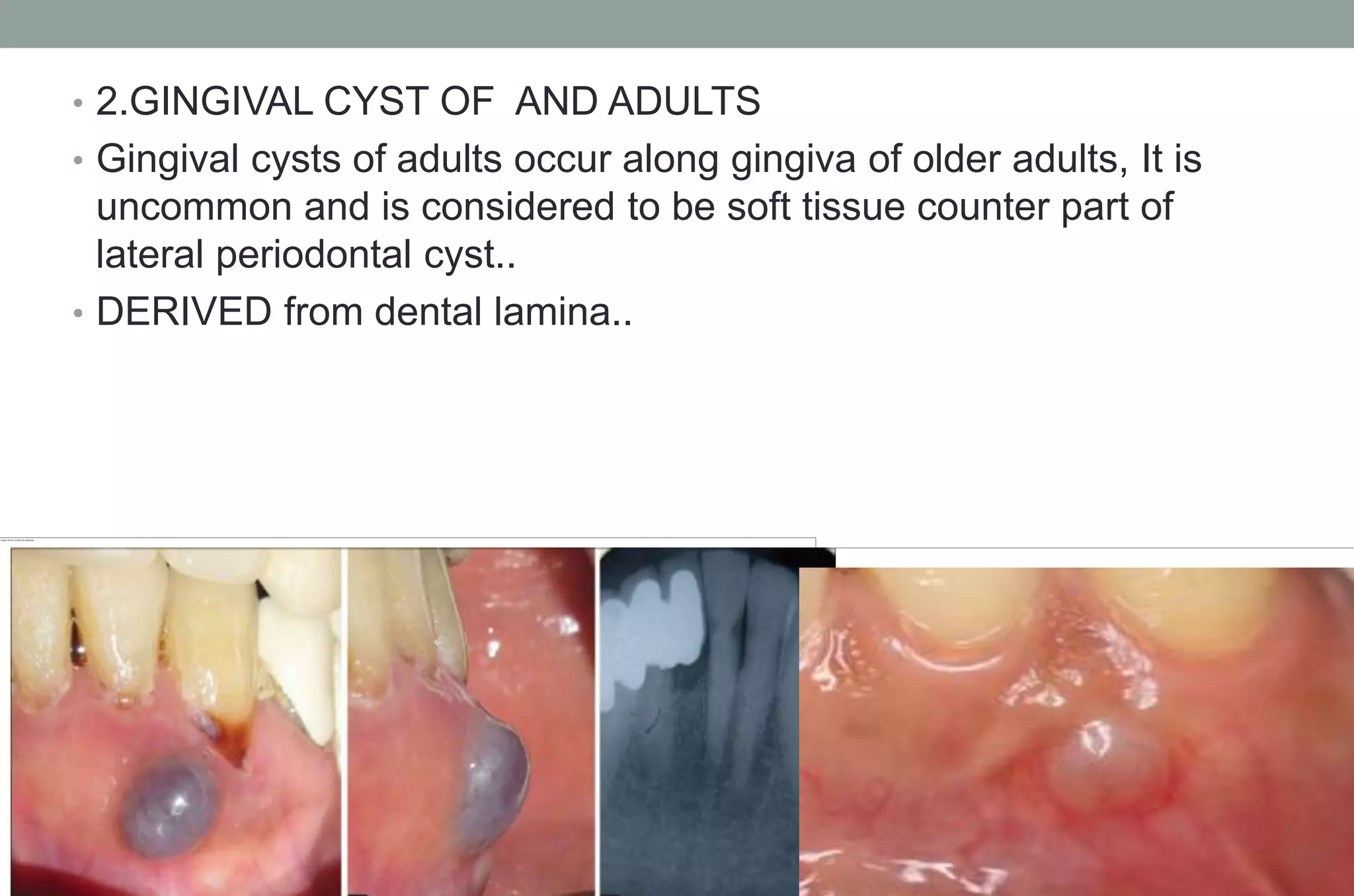 Cyst of oral and maxillofacial regions | PPTX