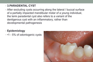 Cyst of oral and maxillofacial regions | PPTX