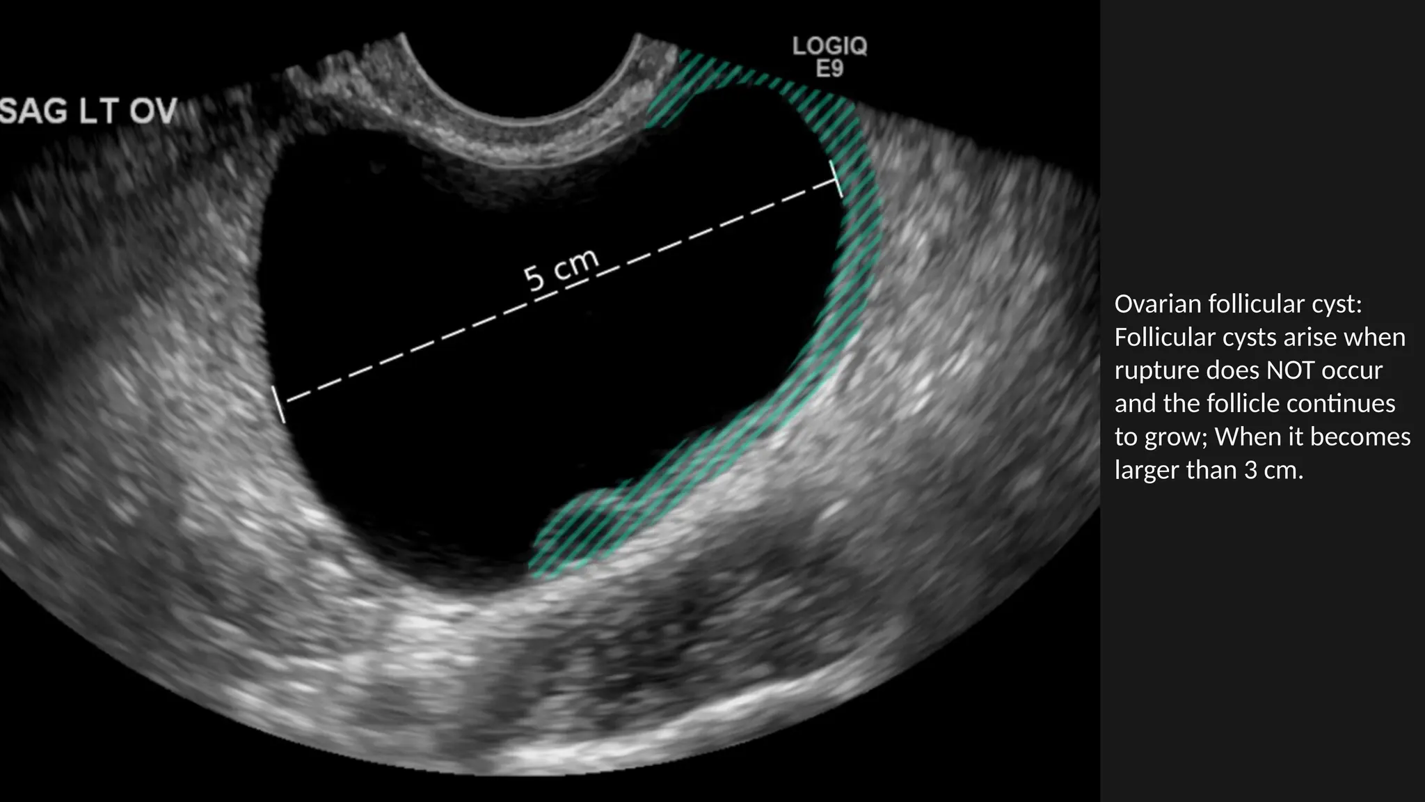 Ovarian Cysts: A Comprehensive Guide to Classification, Clinical ...