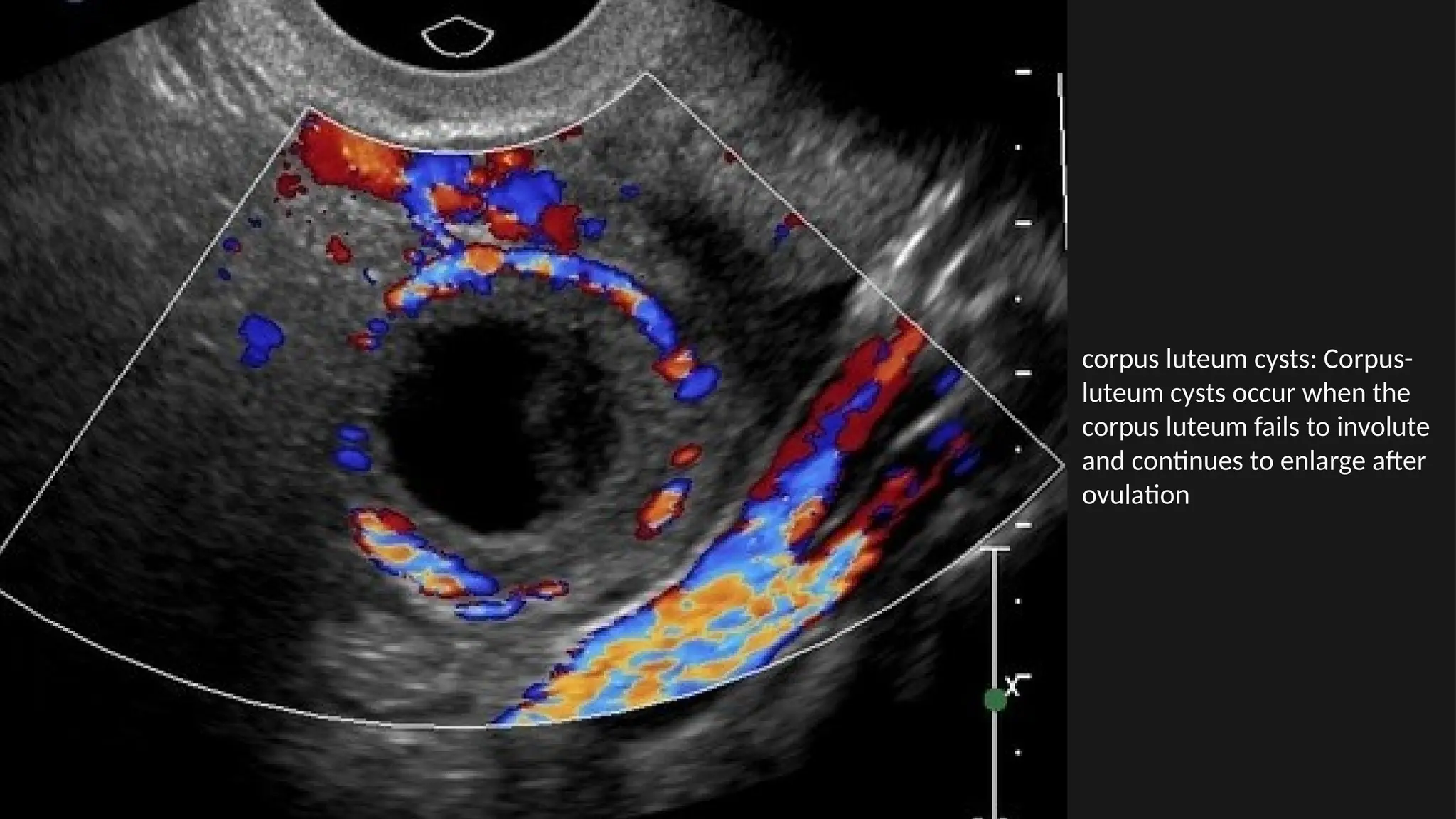 Ovarian Cysts: A Comprehensive Guide to Classification, Clinical ...