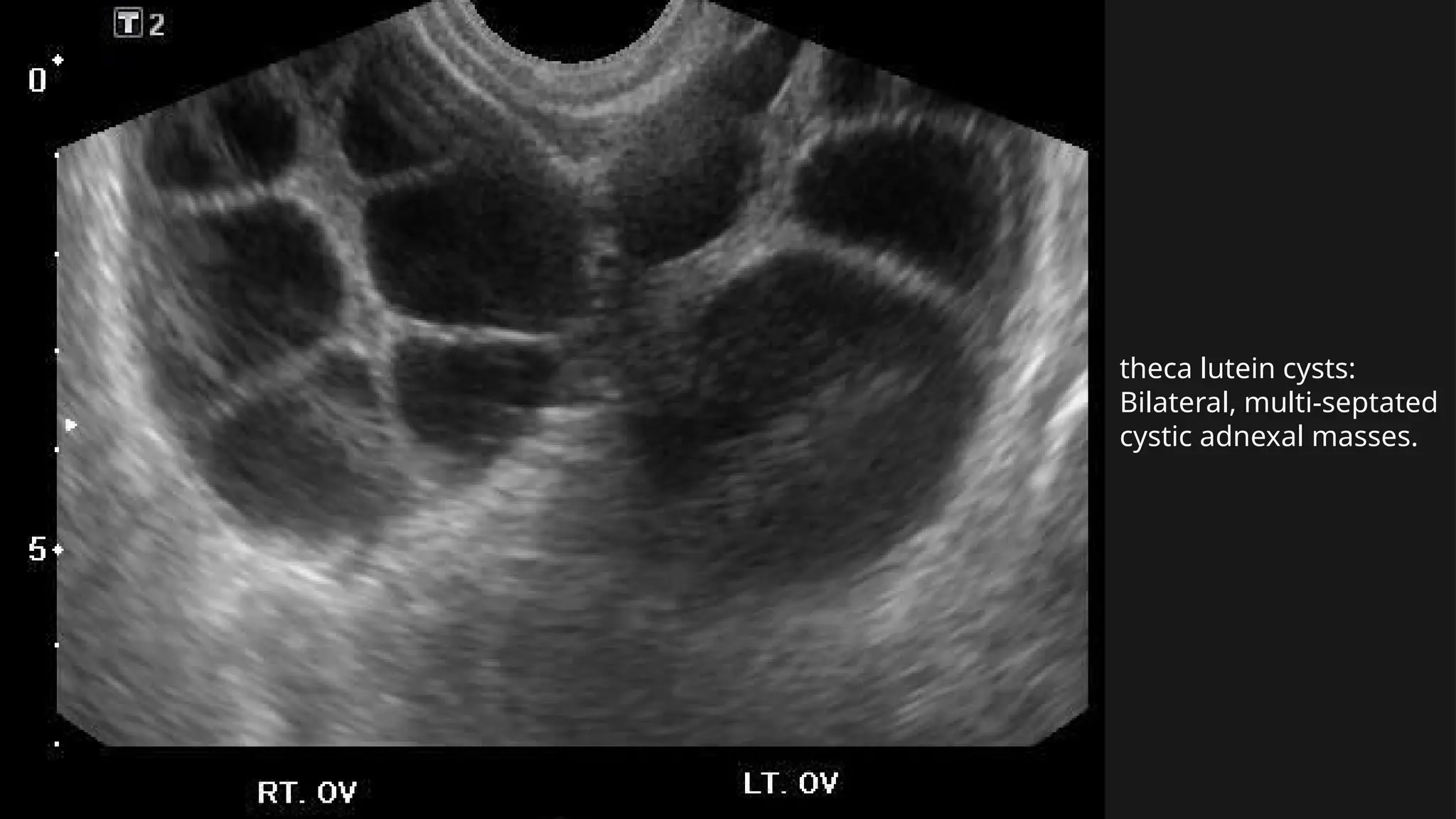 Ovarian Cysts: A Comprehensive Guide to Classification, Clinical ...