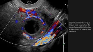 Ovarian Cysts: A Comprehensive Guide to Classification, Clinical ...