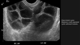Ovarian Cysts: A Comprehensive Guide to Classification, Clinical ...