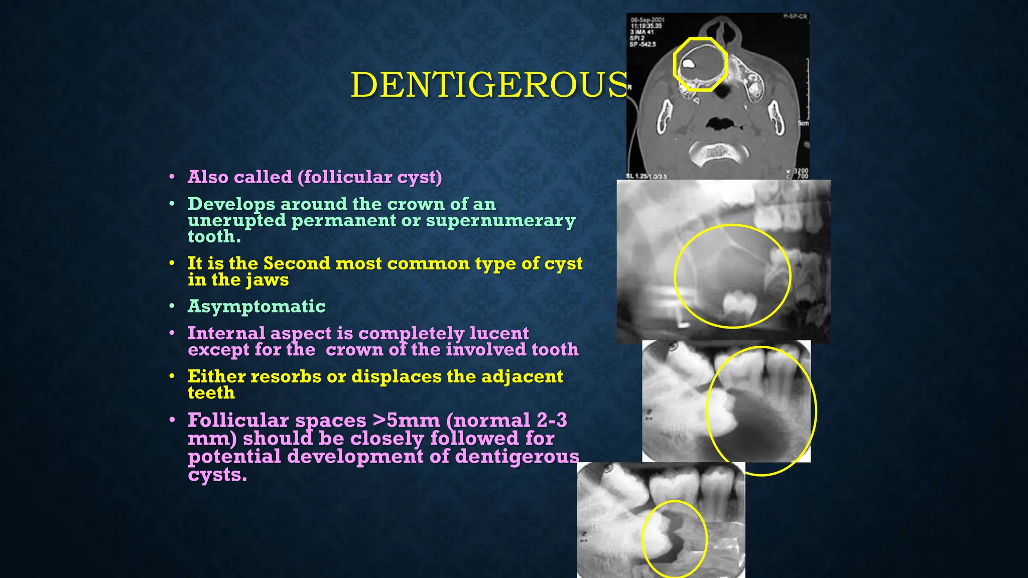 CYSTS OF THE ORAL CAVITY A Cyst is a benign pathologic cavity filled ...