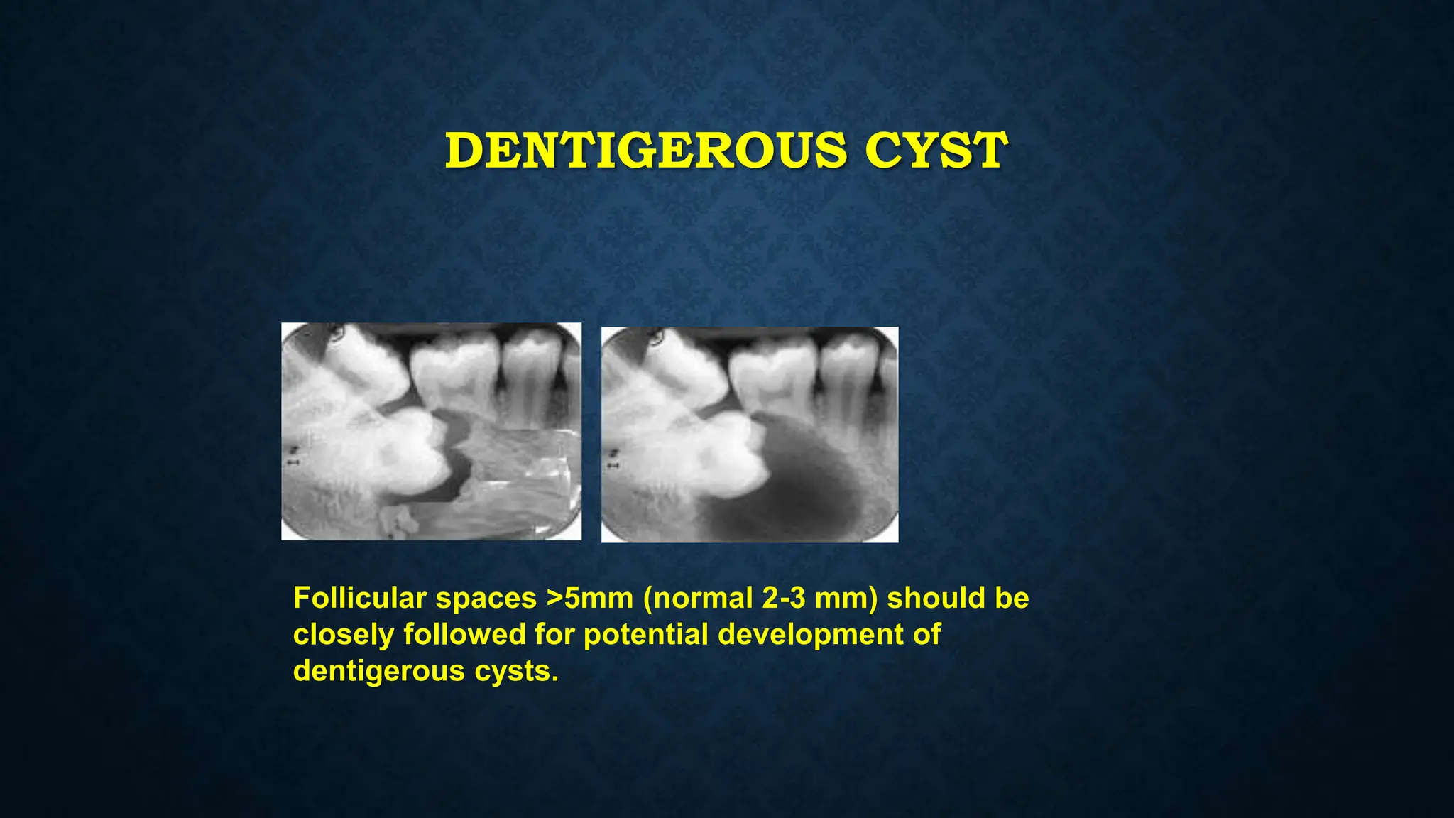 CYSTS OF THE ORAL CAVITY A Cyst is a benign pathologic cavity filled ...