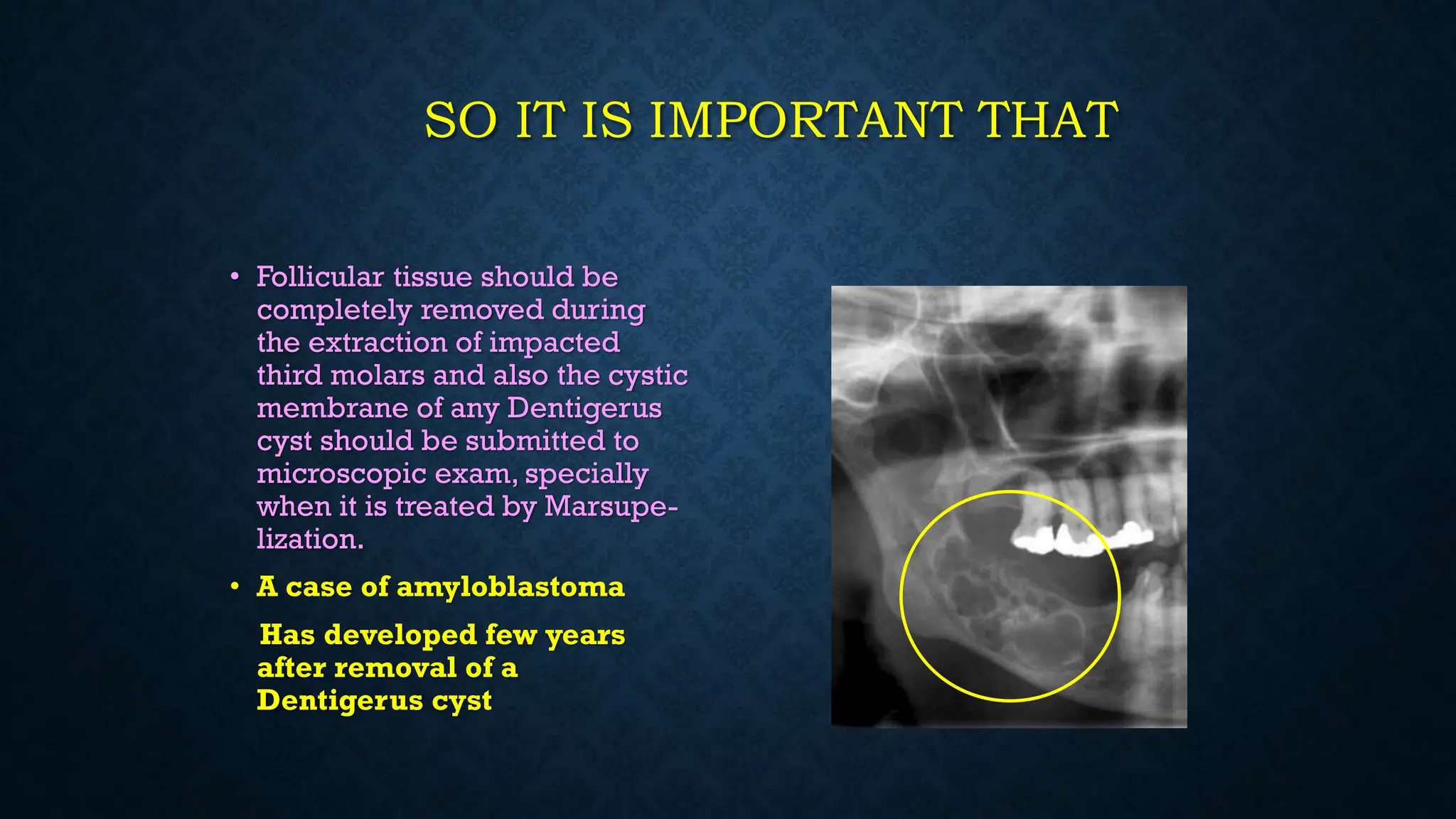 CYSTS OF THE ORAL CAVITY A Cyst is a benign pathologic cavity filled ...