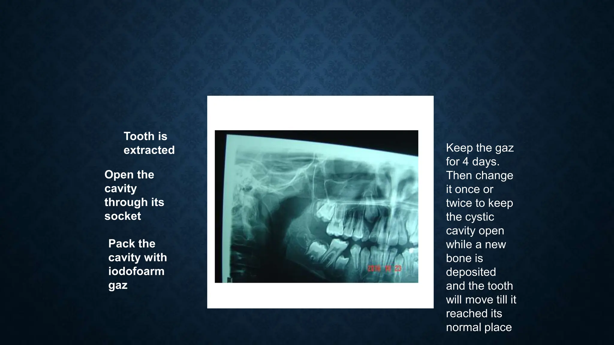 CYSTS OF THE ORAL CAVITY A Cyst is a benign pathologic cavity filled ...