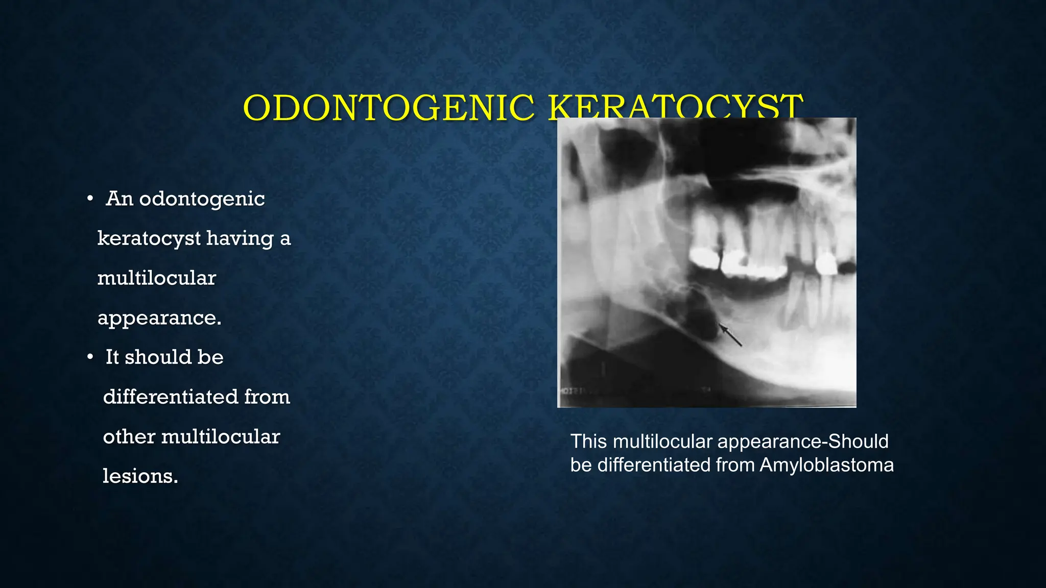 CYSTS OF THE ORAL CAVITY A Cyst is a benign pathologic cavity filled ...