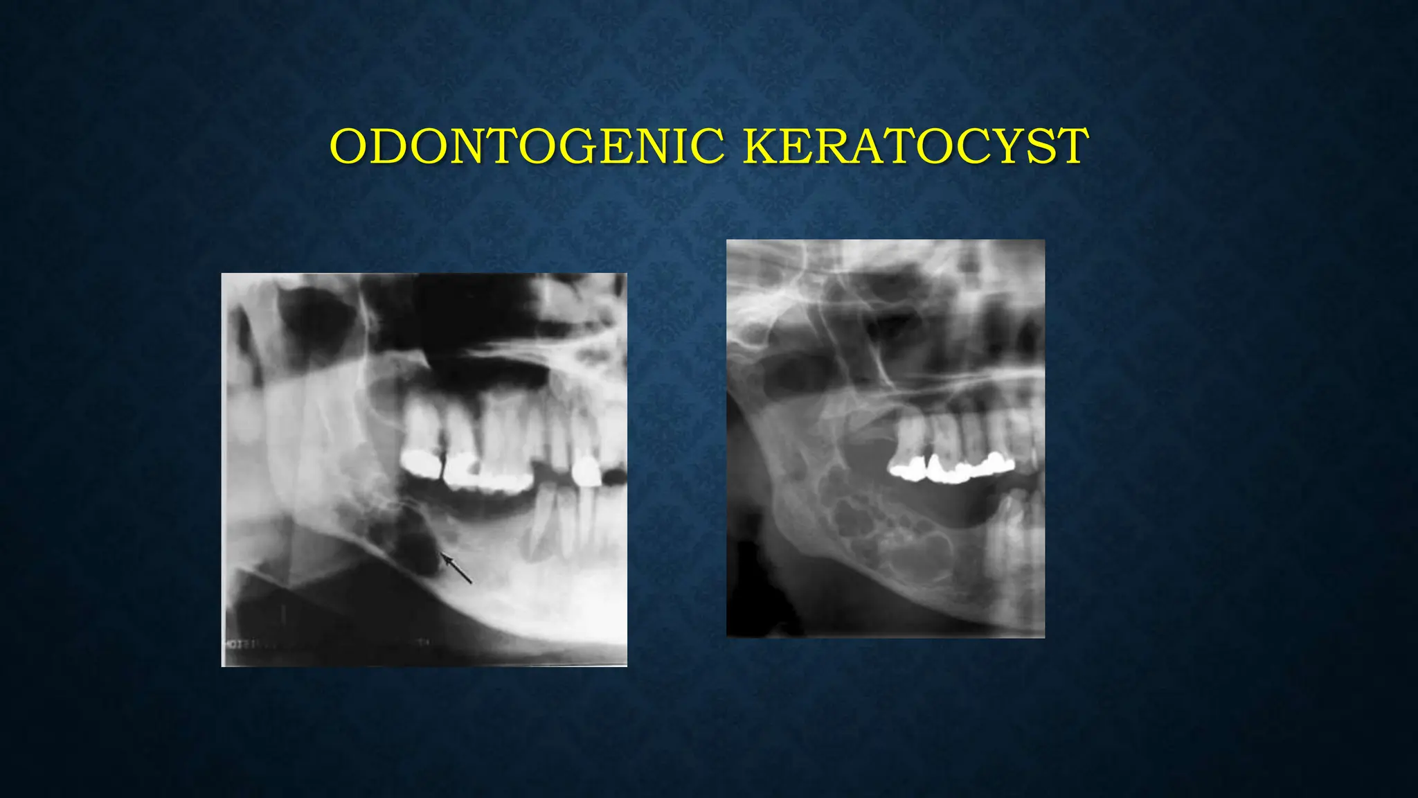CYSTS OF THE ORAL CAVITY A Cyst is a benign pathologic cavity filled ...