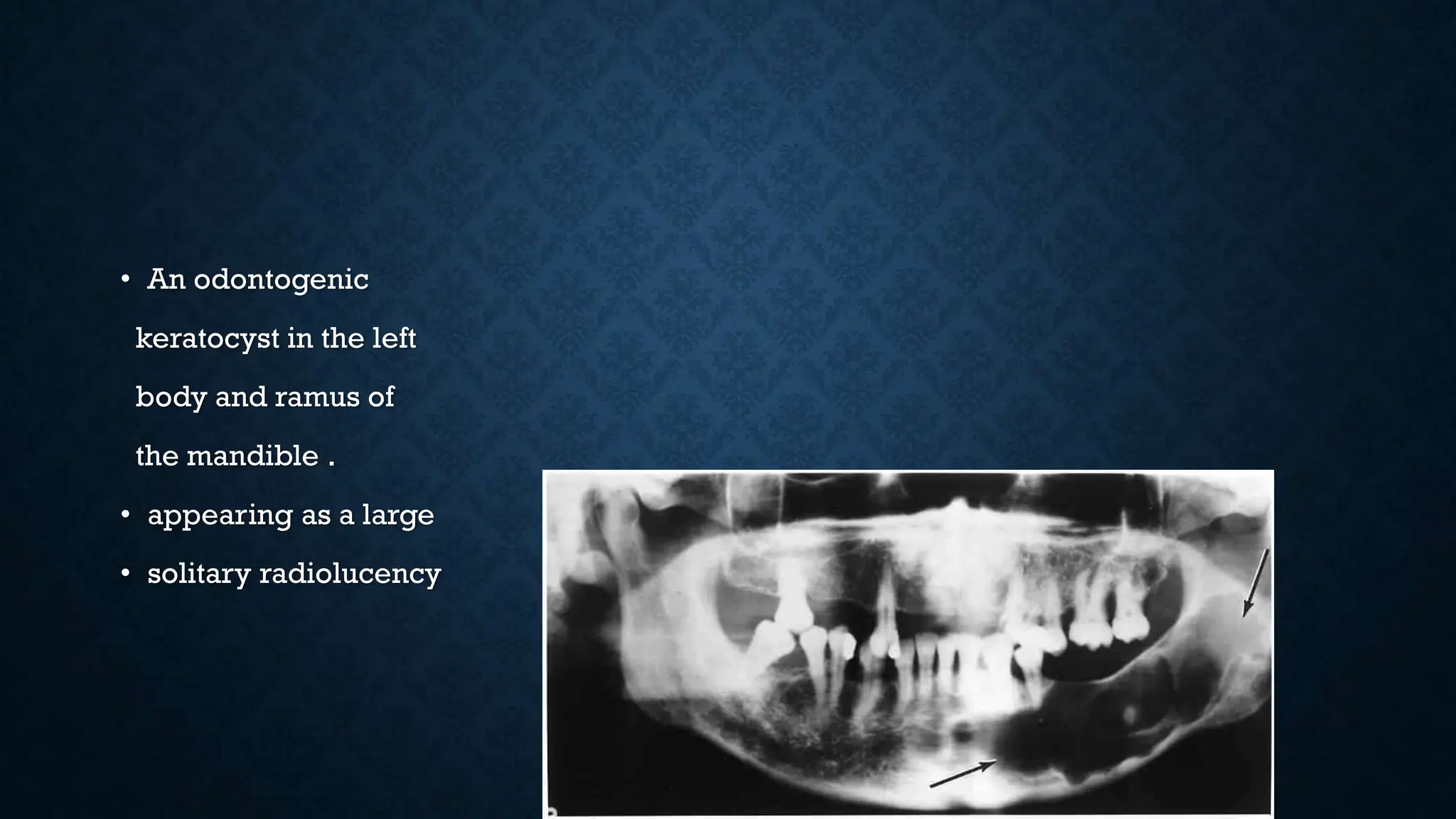 CYSTS OF THE ORAL CAVITY A Cyst is a benign pathologic cavity filled ...