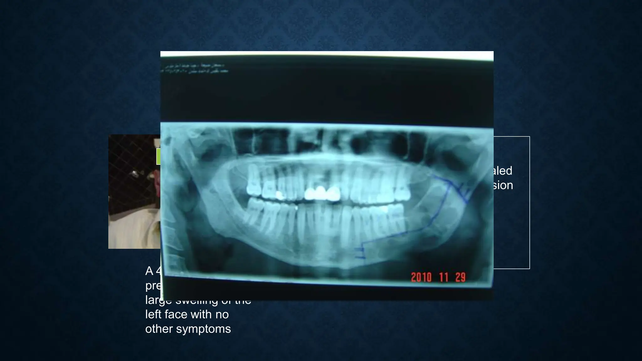 CYSTS OF THE ORAL CAVITY A Cyst is a benign pathologic cavity filled ...