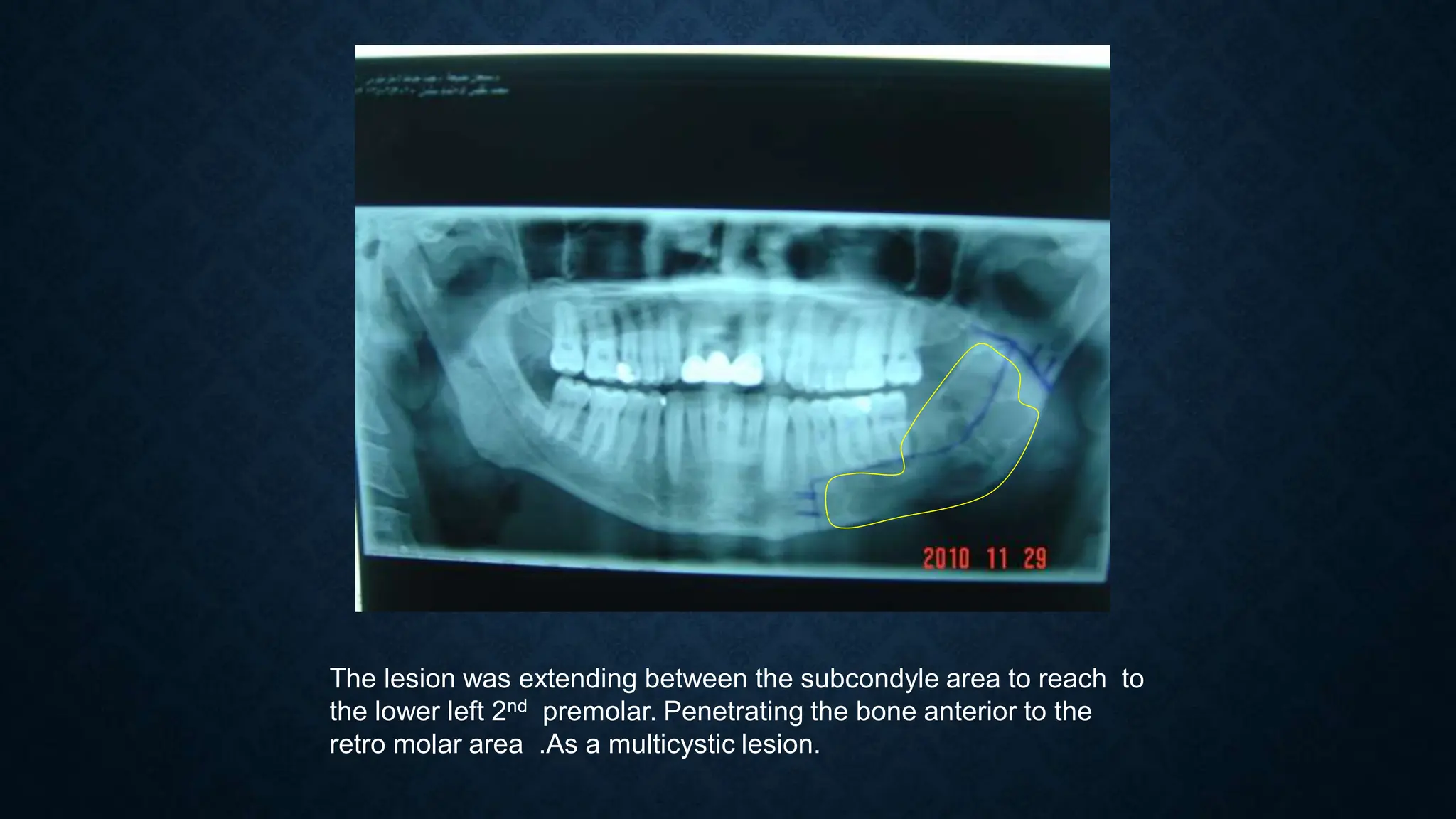 CYSTS OF THE ORAL CAVITY A Cyst is a benign pathologic cavity filled ...