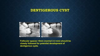 CYSTS OF THE ORAL CAVITY A Cyst is a benign pathologic cavity filled ...