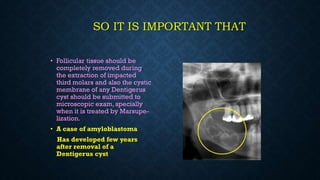 CYSTS OF THE ORAL CAVITY A Cyst is a benign pathologic cavity filled ...