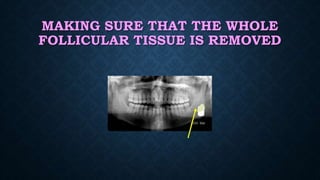 CYSTS OF THE ORAL CAVITY A Cyst is a benign pathologic cavity filled ...