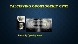 CYSTS OF THE ORAL CAVITY A Cyst is a benign pathologic cavity filled ...