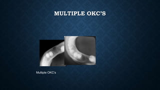 CYSTS OF THE ORAL CAVITY A Cyst is a benign pathologic cavity filled ...