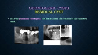 CYSTS OF THE ORAL CAVITY A Cyst is a benign pathologic cavity filled ...