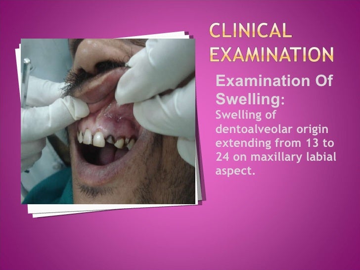 Cyst enucleation by Dr. Anuja Aggarwal
