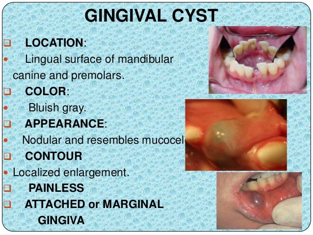 Periodontology Cyst