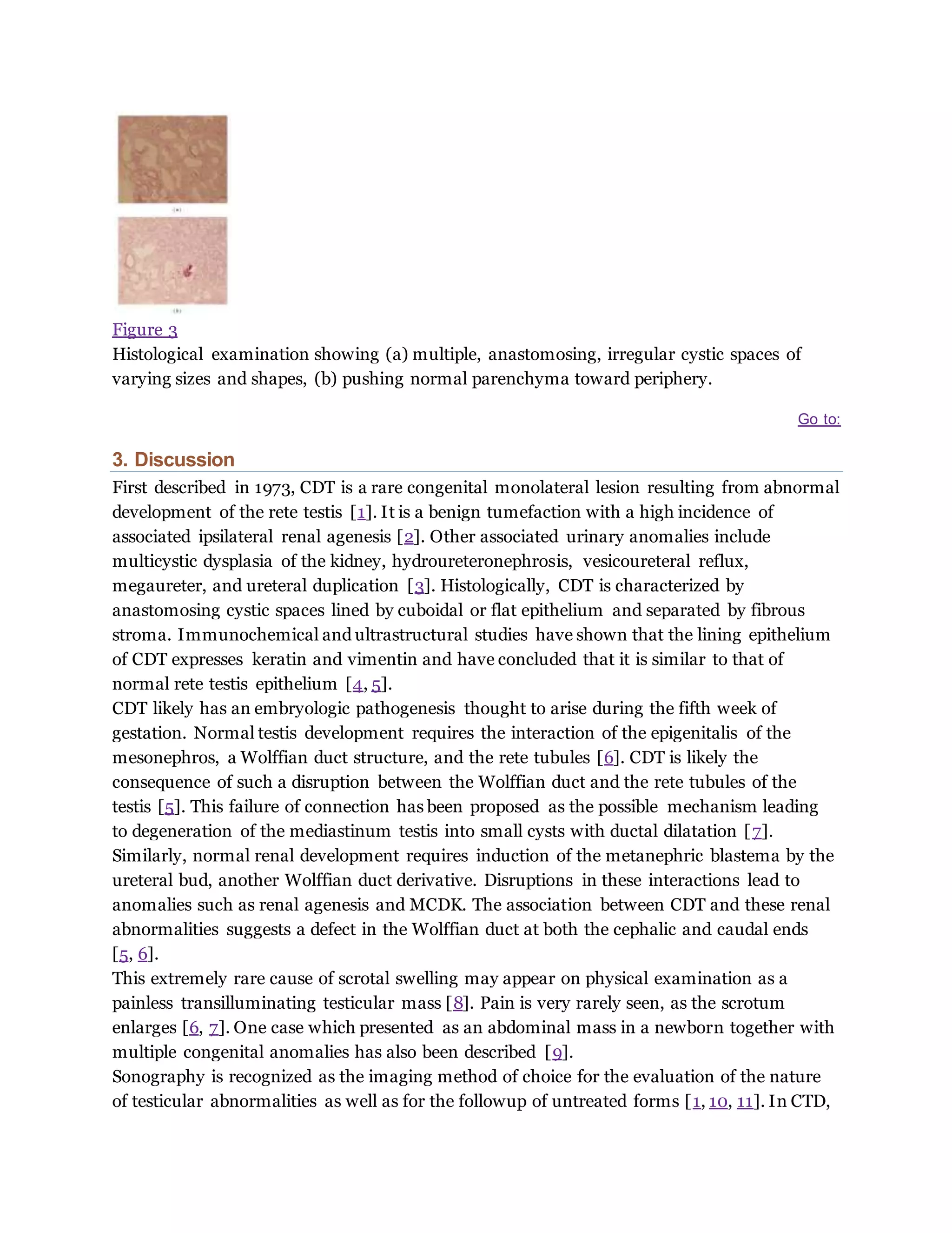 Cystic Dysplasia of the Rete Testis | DOCX
