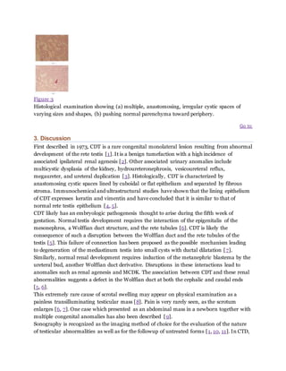 Cystic Dysplasia of the Rete Testis | PDF