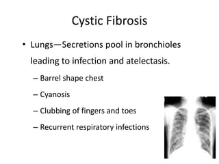 Cystic fibrosis | PPTX | Digestive Disorders | Diseases and Conditions
