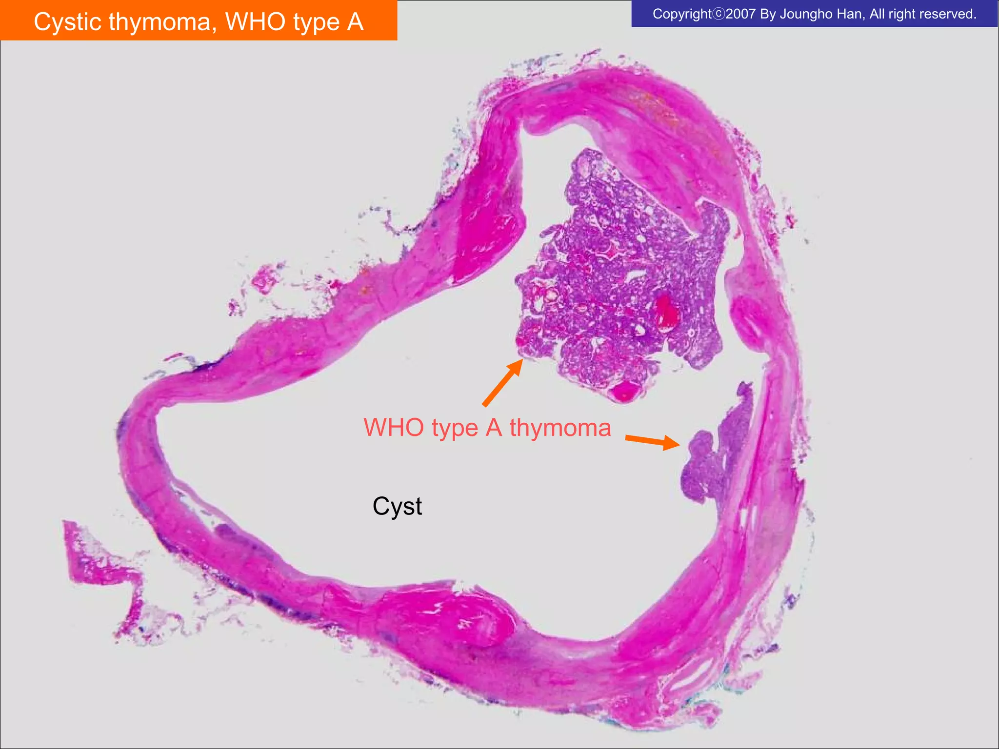 Cystic Thymoma | PPS