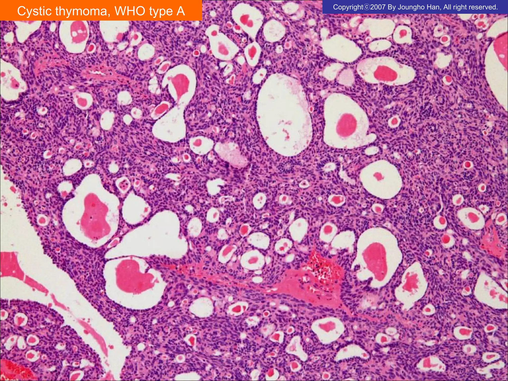 Cystic Thymoma | PPS