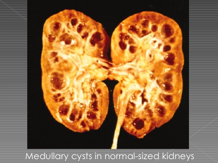 Medullary Cystic Disease