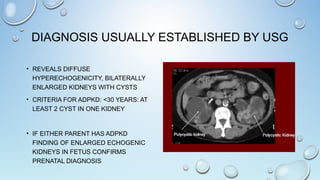 Cystic diseases of kidney | PPT