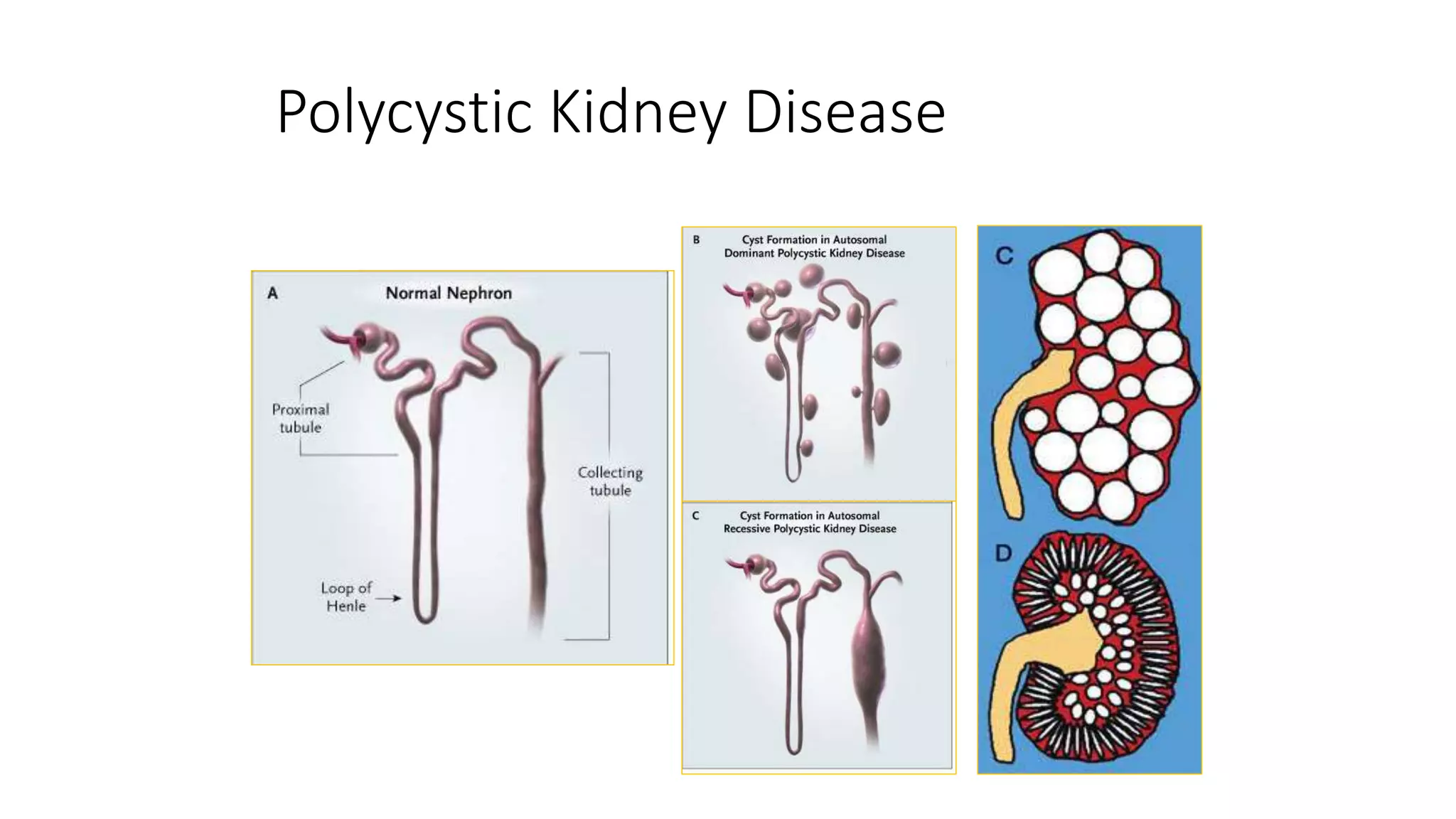 Cystic diseases of kidney | PPTX