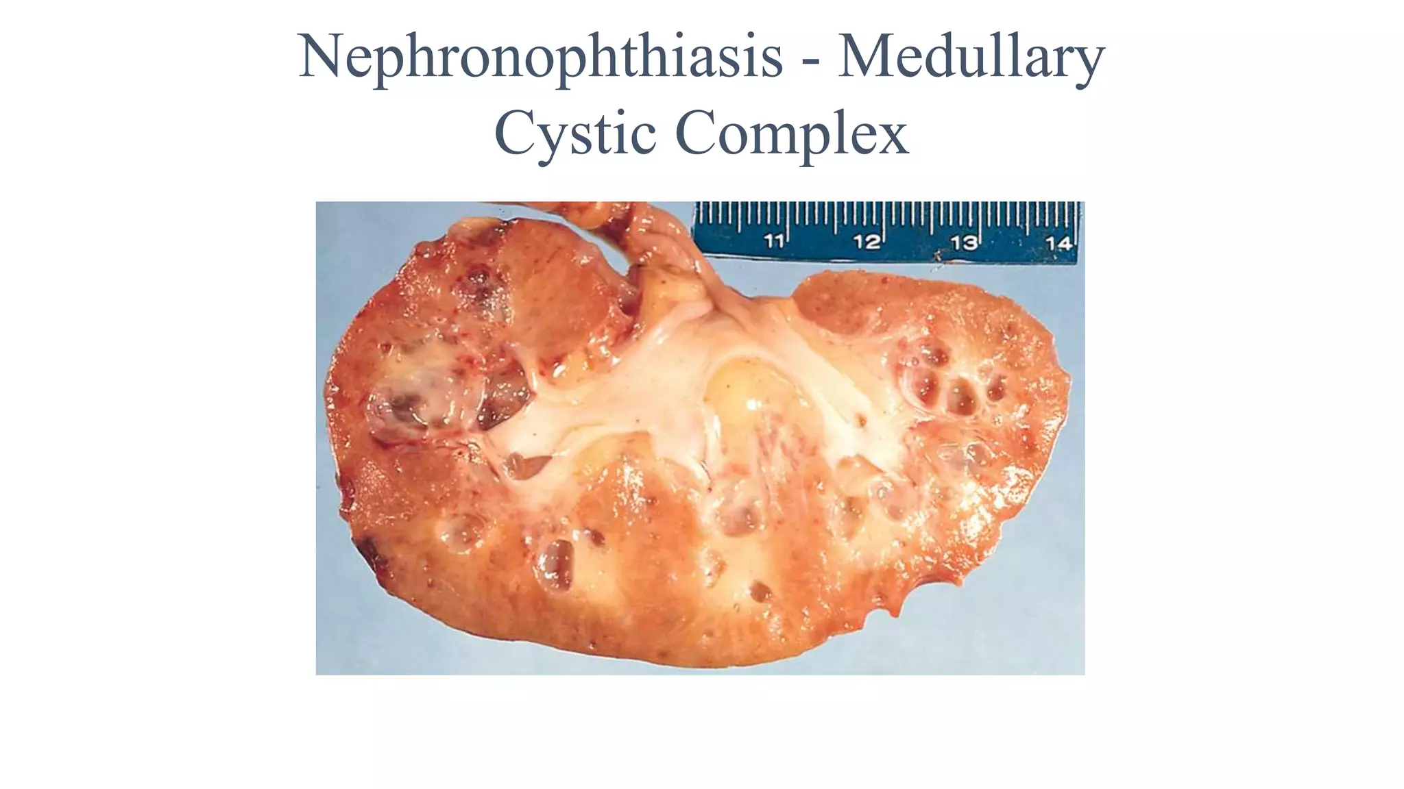 Cystic diseases of kidney | PPTX
