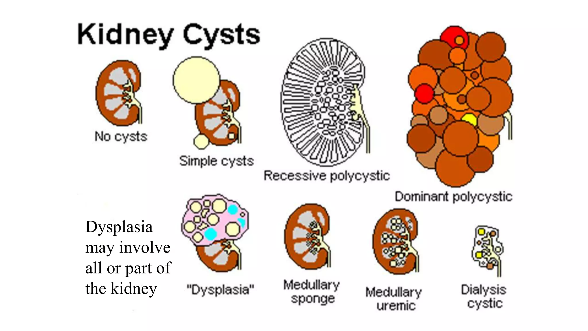 Cystic diseases of kidney | PPTX