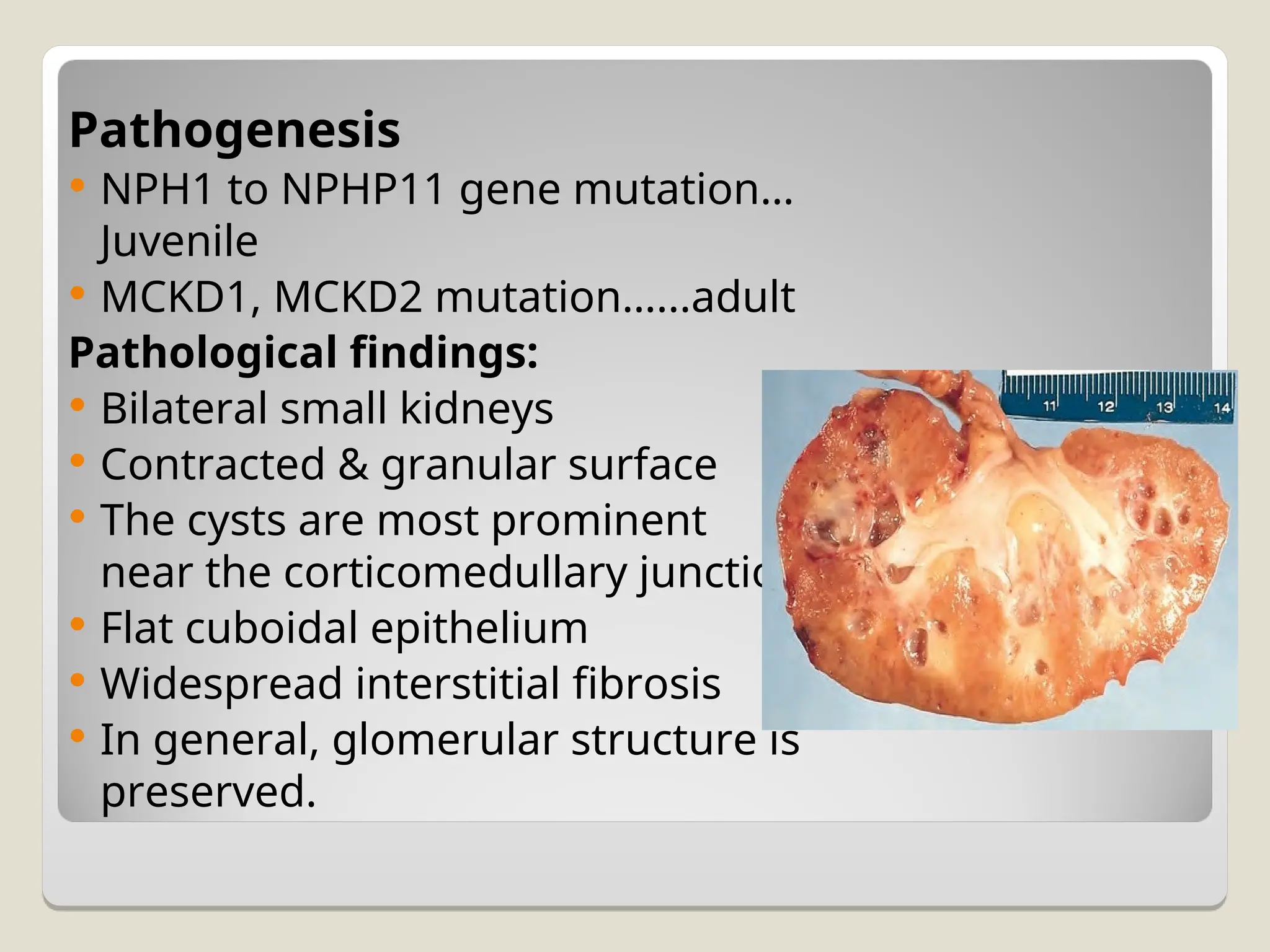 Cystic Diseases of the Kidney; Pathology of major cystic diseases of ...