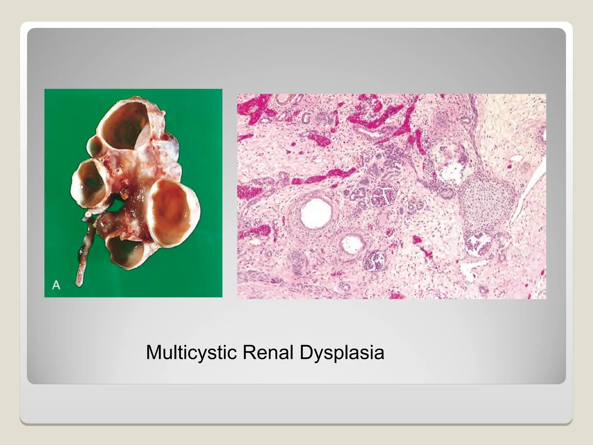 Cystic Diseases of the Kidney; Pathology of major cystic diseases of ...