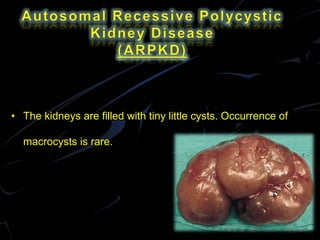 Cystic diseases of the kidney in children | PPTX