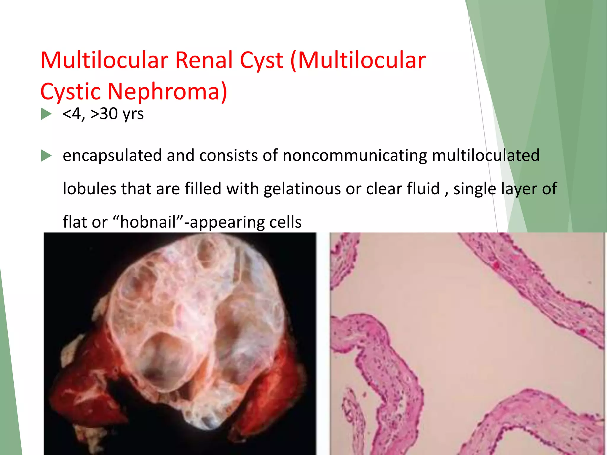Cystic diseases of kidney | PPTX