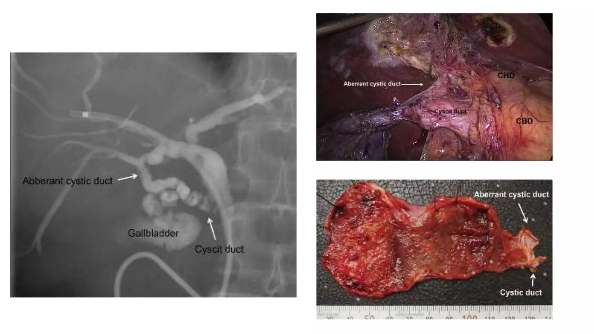Cystic Duct Normal Anatomy and Anatomic Variants.pptx