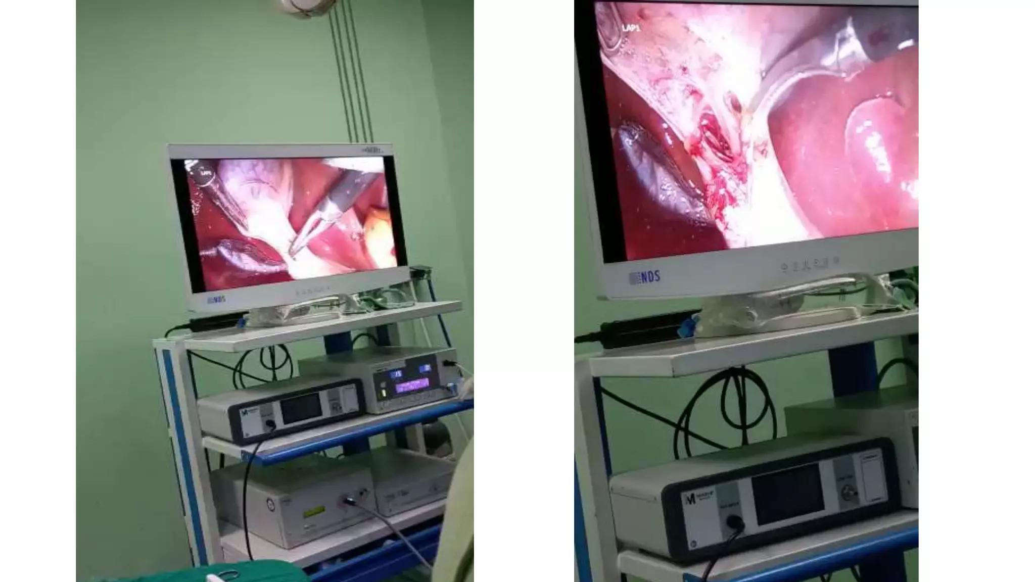 Cystic Duct Normal Anatomy and Anatomic Variants.pptx