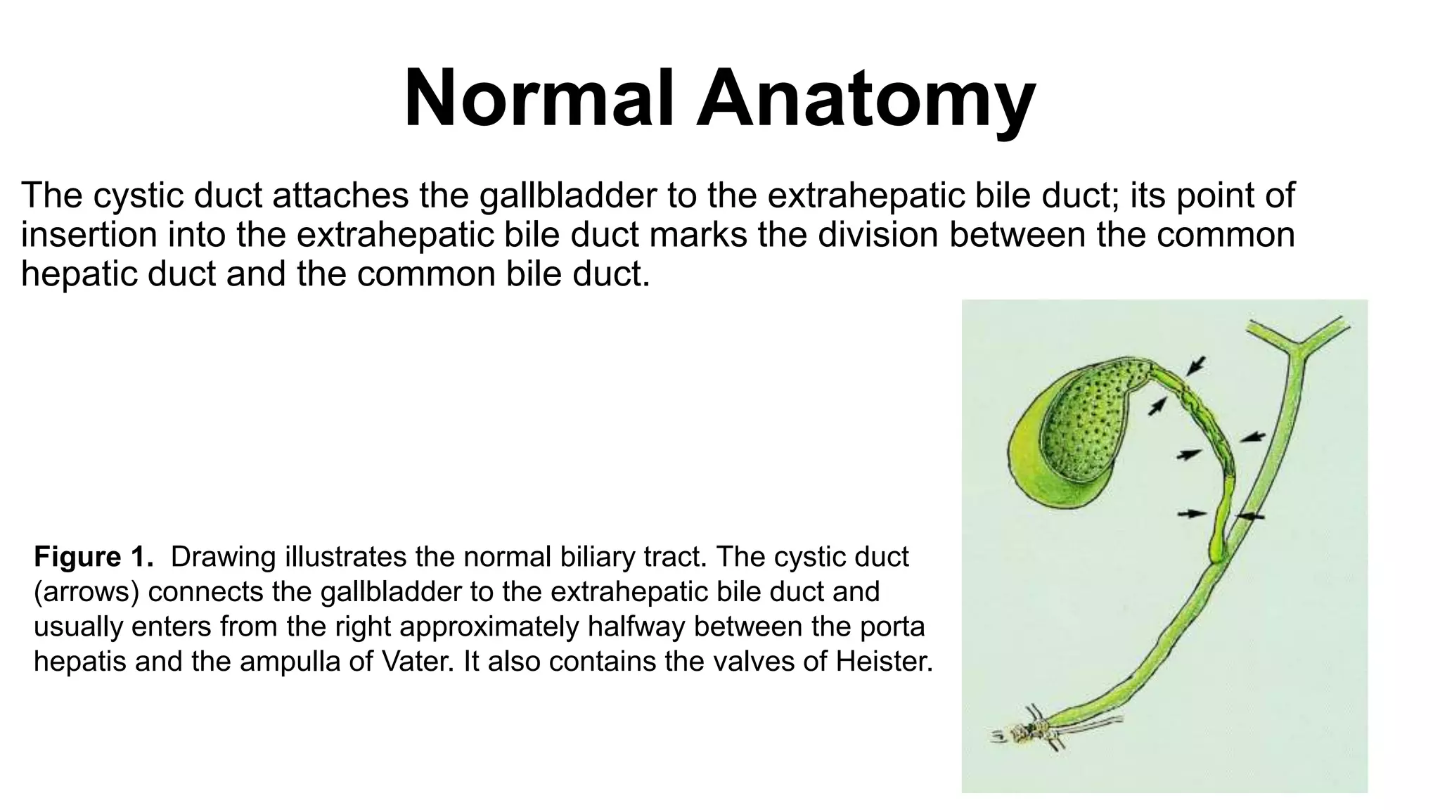 Cystic Duct Normal Anatomy and Anatomic Variants.pptx
