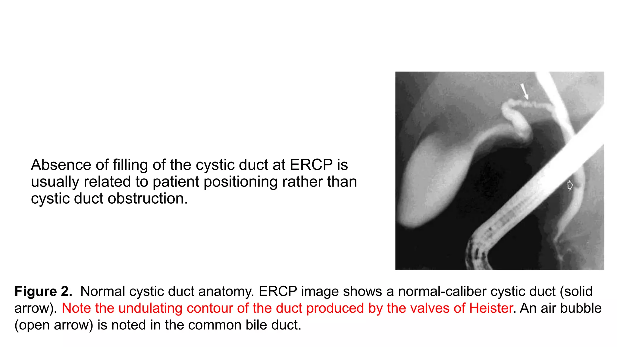 Cystic Duct Normal Anatomy and Anatomic Variants.pptx